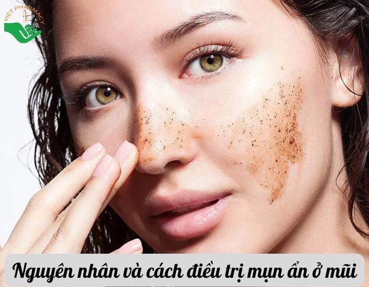 Nguyên nhân và cách điều trị mụn ẩn ở mũi hiệu quả